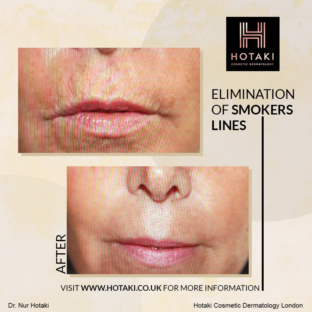 Permanent Elimination of Smokers Lines: A Revolutionary Nonsurgical ...